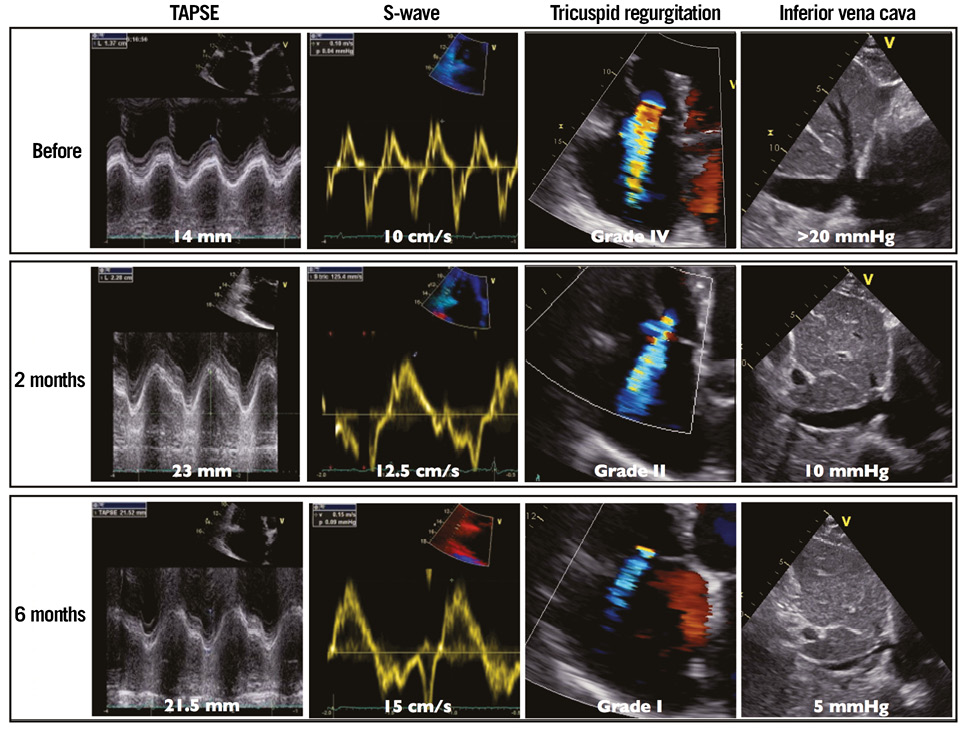 How should I treat refractory cardiogenic shock in a patient with ...