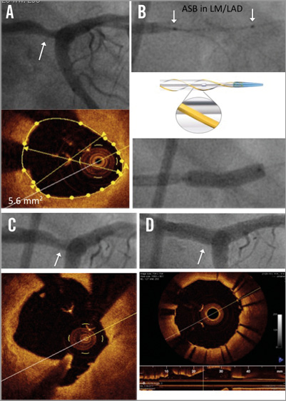 Safety and efficacy of lesion preparation with the AngioSculpt Scoring ...