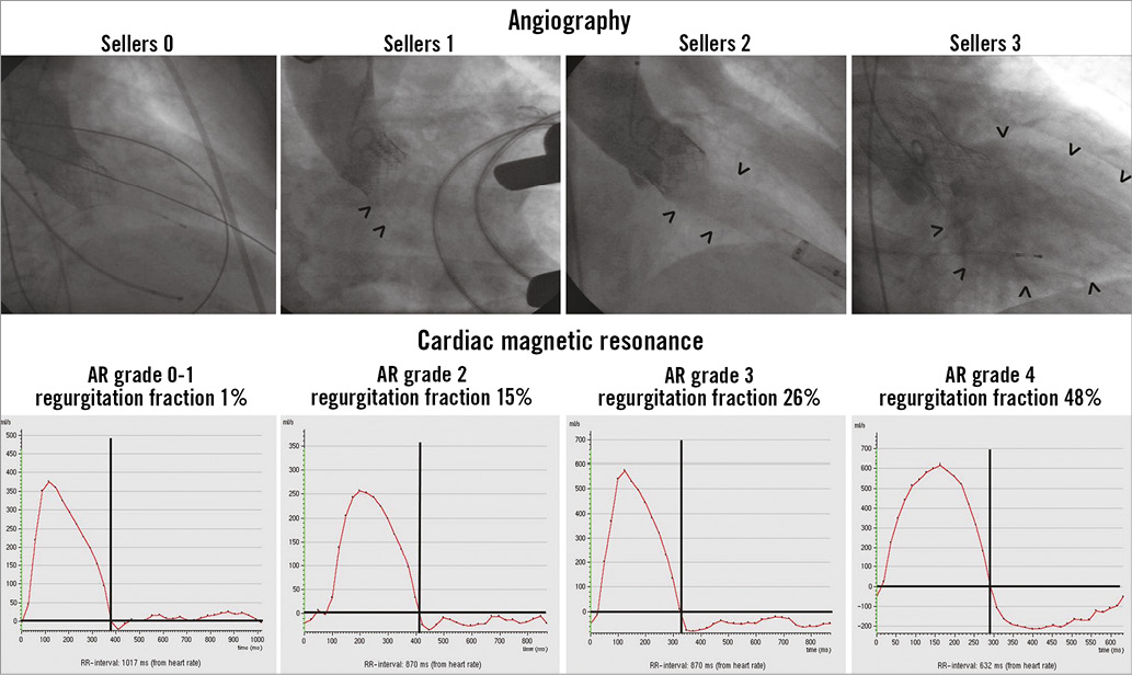 Evaluation of aortic regurgitation after transcatheter aortic valve ...