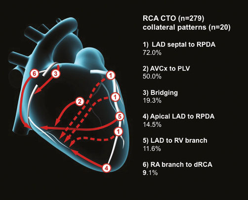 The collateral circulation of coronary chronic total occlusions ...