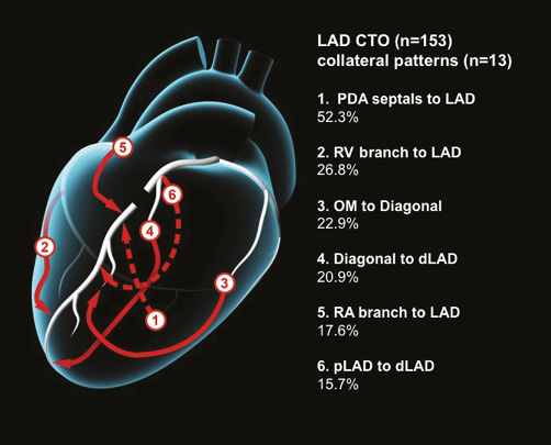 The collateral circulation of coronary chronic total occlusions ...