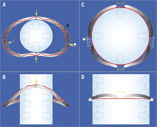 New expandable mitral annuloplasty ring facilitates transcatheter ...