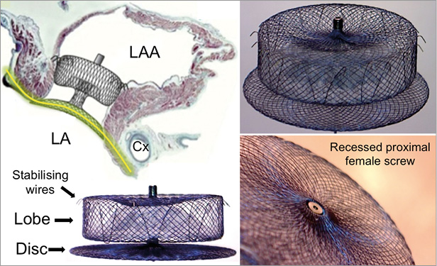 Left atrial appendage occlusion with the AMPLATZER Amulet device: an ...