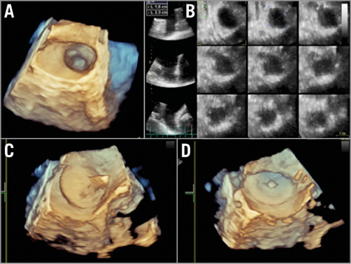 Left atrial appendage occlusion with the AMPLATZER Amulet device: an ...