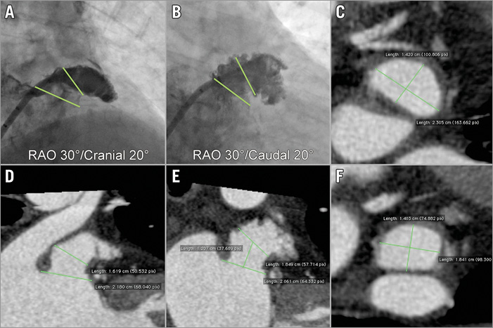 Left atrial appendage occlusion with the AMPLATZER Amulet device: an ...