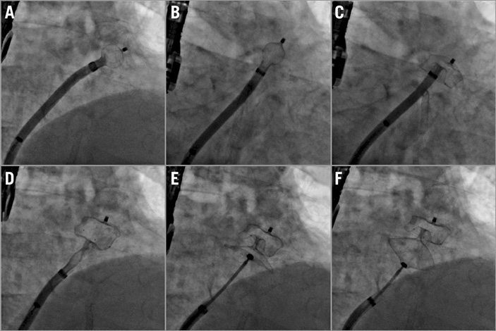 Left atrial appendage occlusion with the AMPLATZER Amulet device: an ...