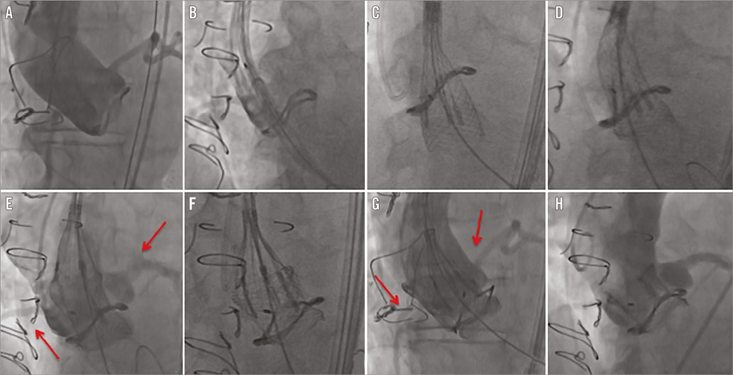 First Lotus aortic valve-in-valve implantation to treat degenerated ...