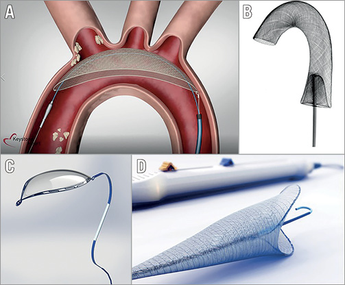 TAVI and the brain: update on definitions, evidence of neuroprotection ...