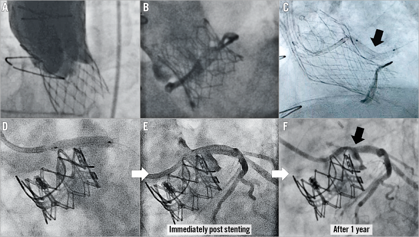Bioprosthetic or native aortic scallop intentional laceration to ...