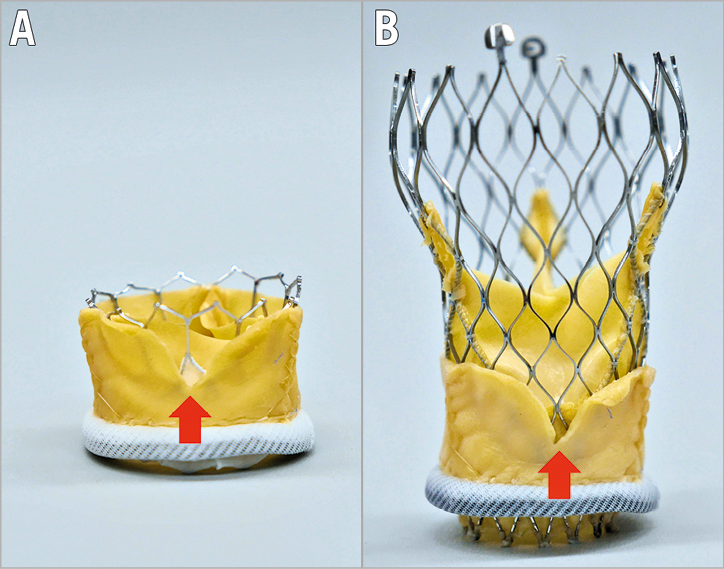 Bioprosthetic or native aortic scallop intentional laceration to ...