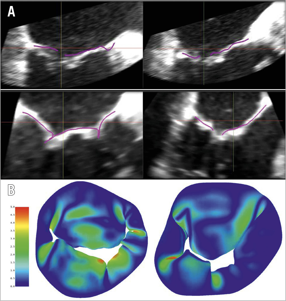 Transoesophageal echocardiography-based computational simulation of the ...