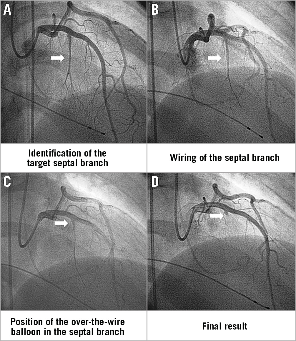 Alcohol septal ablation for hypertrophic obstructive cardiomyopathy: a ...