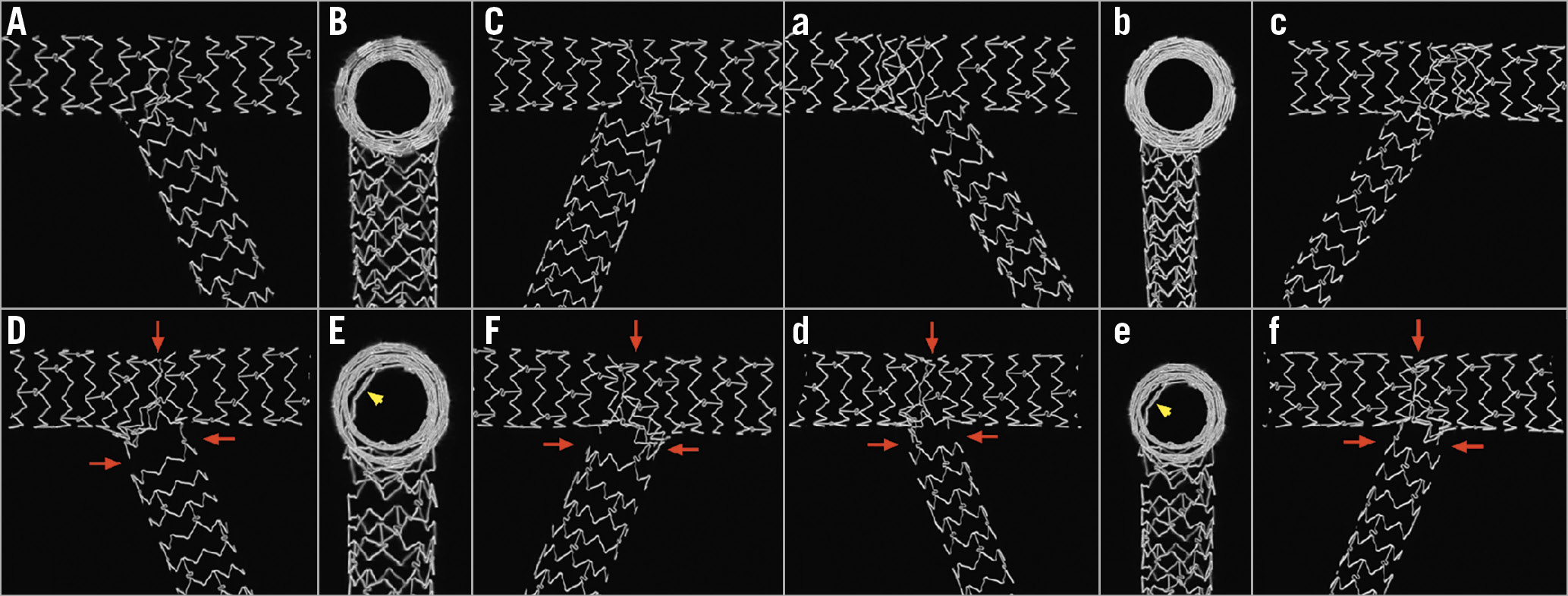 Double kissing mini-culotte versus mini-culotte stenting: insights from ...