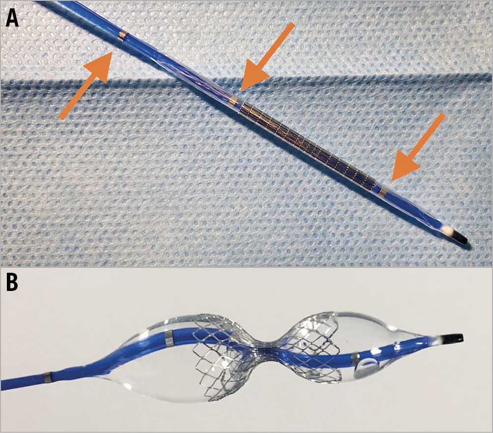 Technical aspects in coronary sinus Reducer implantation - EuroIntervention