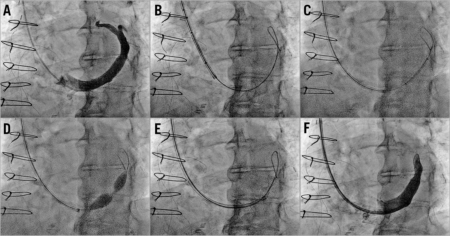Technical aspects in coronary sinus Reducer implantation - EuroIntervention