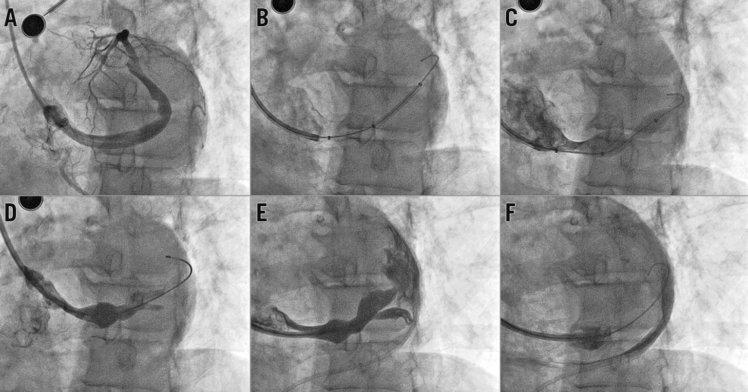 Technical aspects in coronary sinus Reducer implantation - EuroIntervention