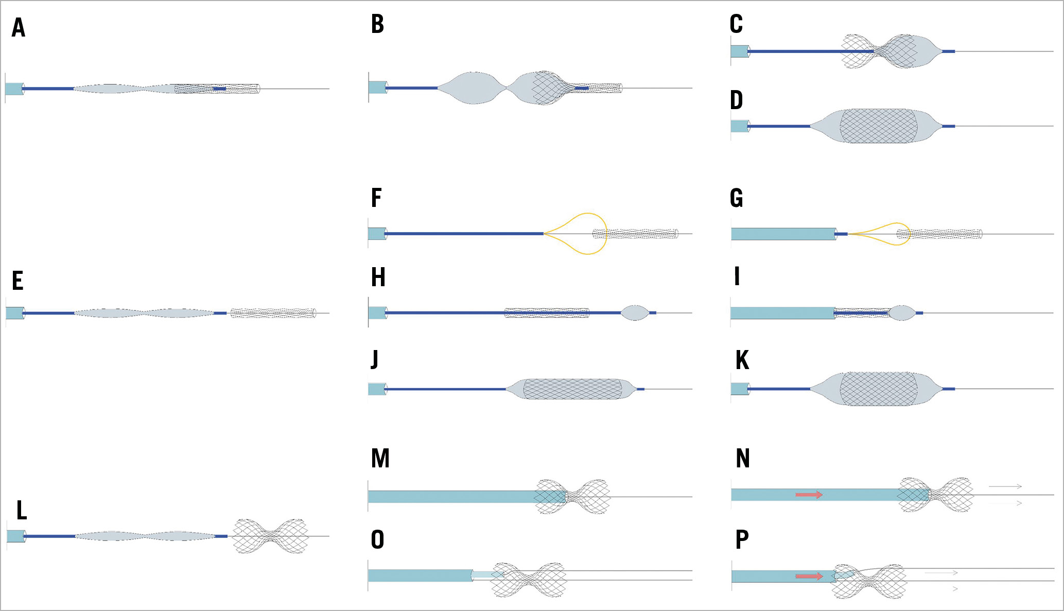 Technical aspects in coronary sinus Reducer implantation - EuroIntervention
