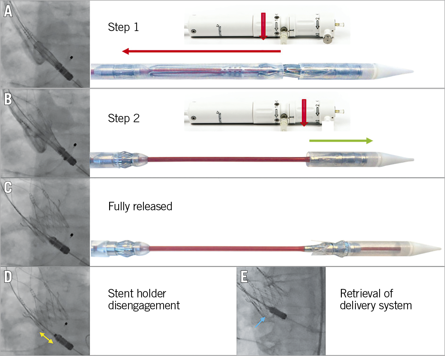 Transcatheter aortic valve implantation with the ACURATE neo valve ...