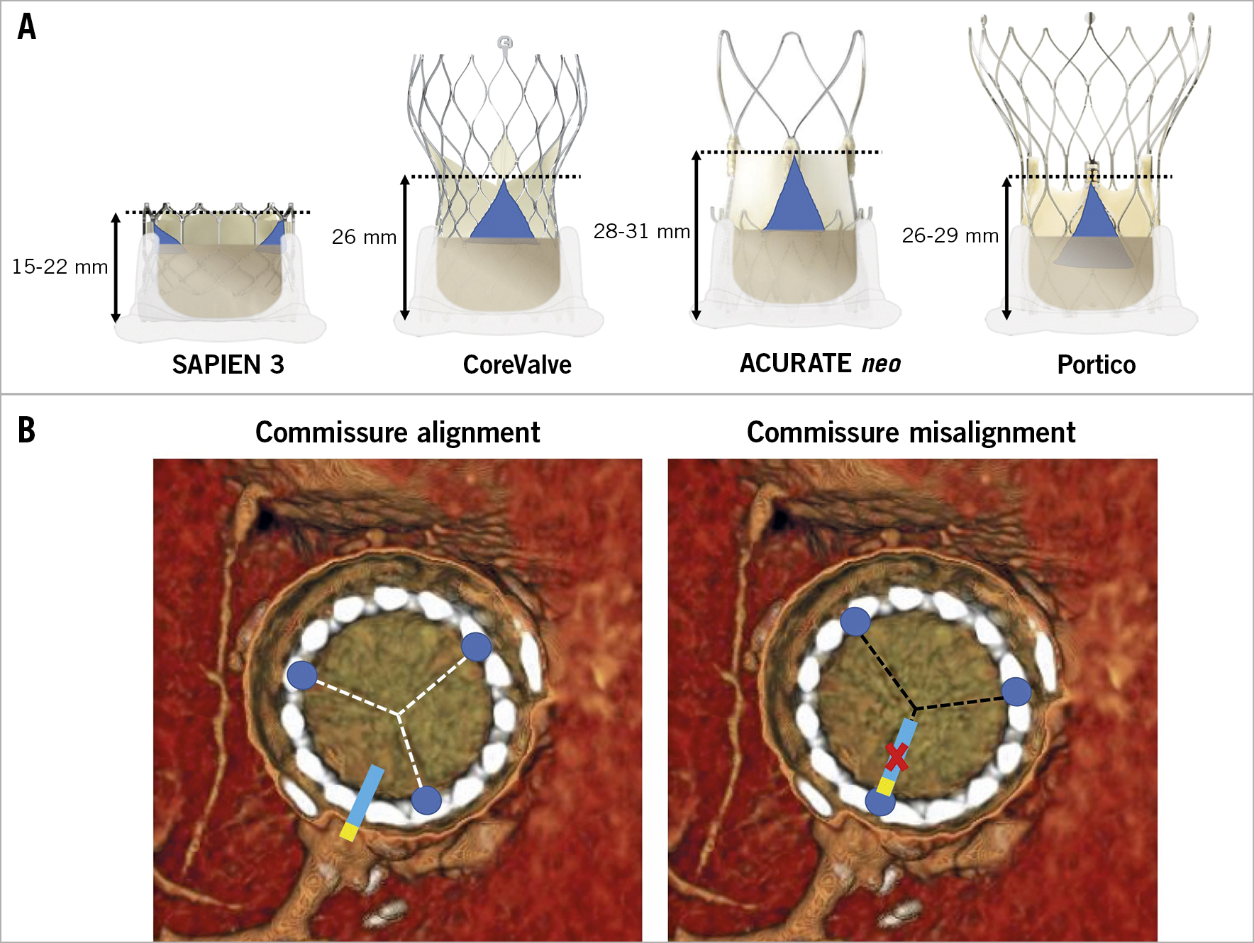Transcatheter Aortic Valve Implantation In Degenerated Surgical Aortic Transcatheter Aortic Valve Implantation In Degenerated Surgical Aortic