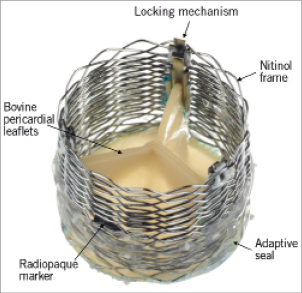 Boston Scientific Lotus valve - EuroIntervention