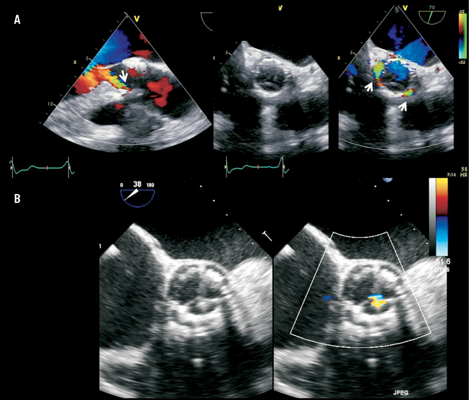 Imaging and quantification of aortic regurgitation after TAVI - EuroIntervention