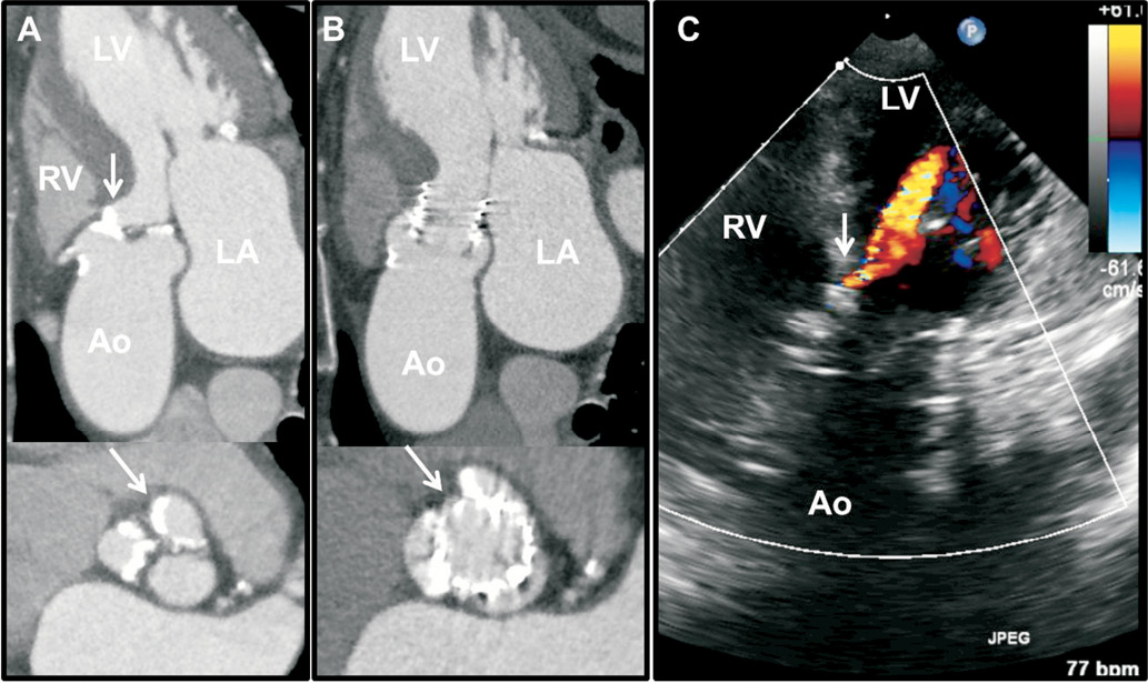 Imaging and quantification of aortic regurgitation after TAVI ...