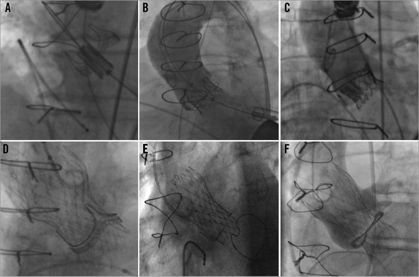 Failing surgical bioprosthesis in aortic and mitral position ...