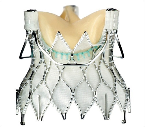 Medtronic Engager™ bioprosthesis for transapical transcatheter aortic ...