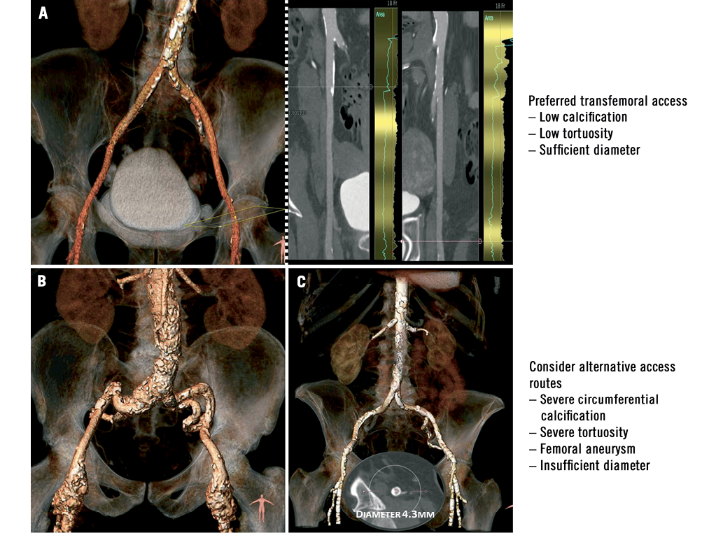 Transcatheter aortic valve implantation: the transfemoral access route ...