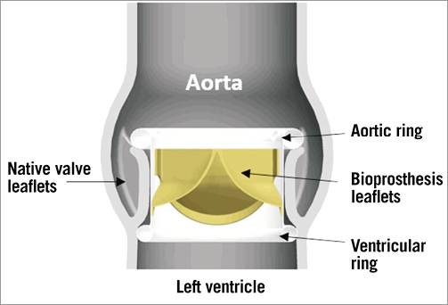 New-generation TAVI devices: description and specifications ...