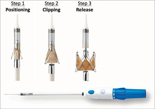 New-generation TAVI devices: description and specifications ...
