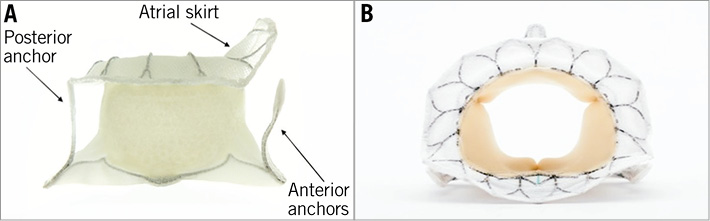 Transcatheter mitral valve implantation with Tiara bioprosthesis ...
