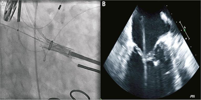 Transcatheter mitral valve implantation with Tiara bioprosthesis ...