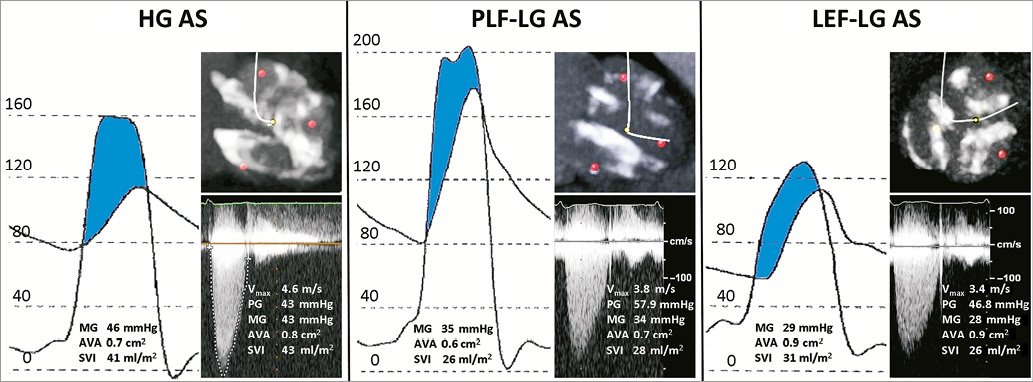 Assessment of low-flow, low-gradient, severe aortic stenosis: an ...