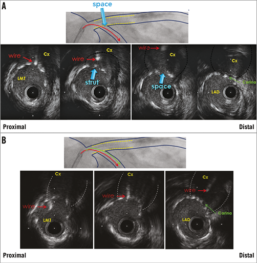 IVUS in bifurcation stenting: what have we learned? - EuroIntervention