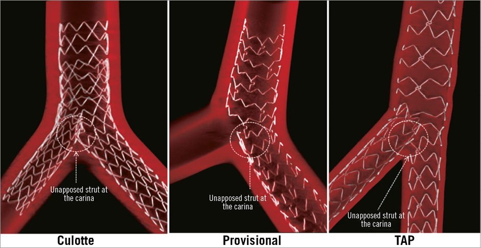 Final kissing balloon inflation: the whole story - EuroIntervention