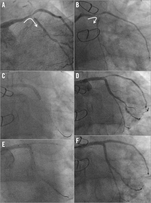 Technical aspects of the T And small Protrusion (TAP) technique ...