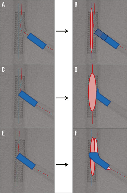 Technical aspects of the T And small Protrusion (TAP) technique ...