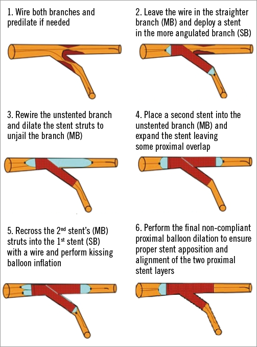 Technical aspects of the culotte technique - EuroIntervention