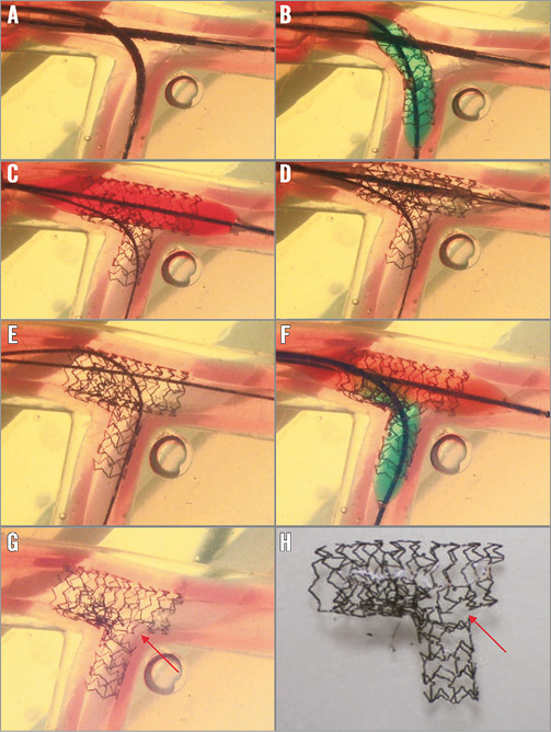 Classic crush and DK crush stenting techniques - EuroIntervention