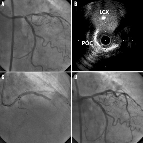 When and how to perform the provisional approach for distal LM stenting ...