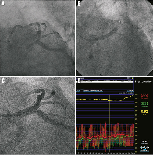 When and how to perform the provisional approach for distal LM stenting ...