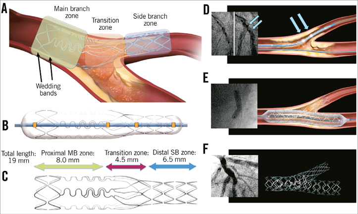 The Tryton Side Branch Stent - EuroIntervention