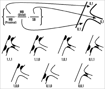 Definitions and classifications of bifurcation lesions and treatment ...