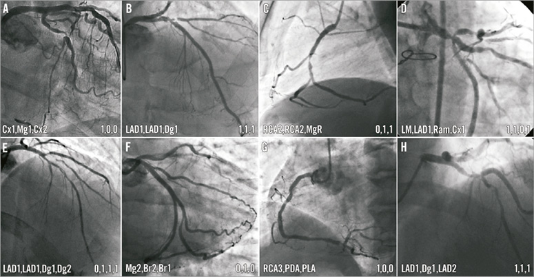 Definitions and classifications of bifurcation lesions and treatment ...