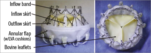 The CardiAQ transcatheter mitral valve implantation system ...