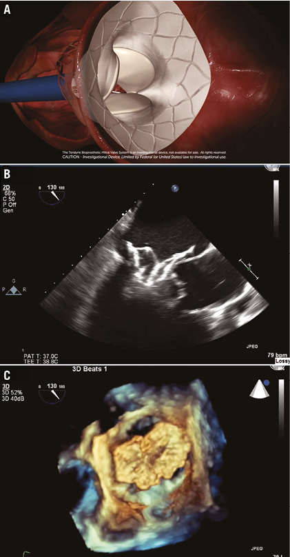 The Tendyne transcatheter mitral valve implantation system ...