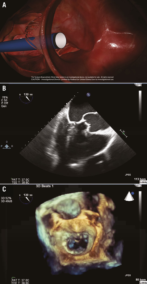 The Tendyne transcatheter mitral valve implantation system ...