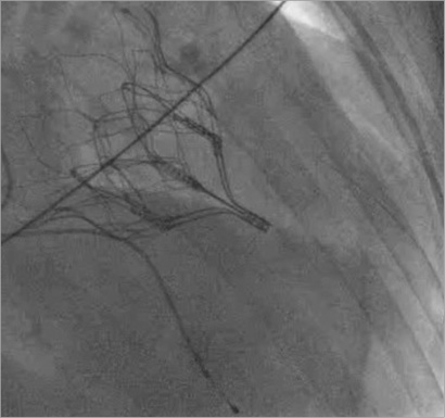 The Tendyne transcatheter mitral valve implantation system ...