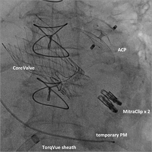 TAVI and concomitant procedures: from PCI to LAA closure - EuroIntervention